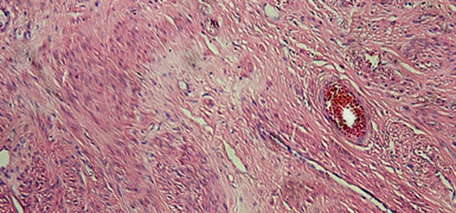 Les différentes modalités thérapeutiques pour le traitement curatif des ...